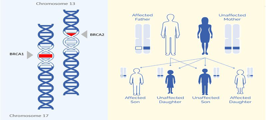 Hereditary aspects of breast cancer - Express Healthcare